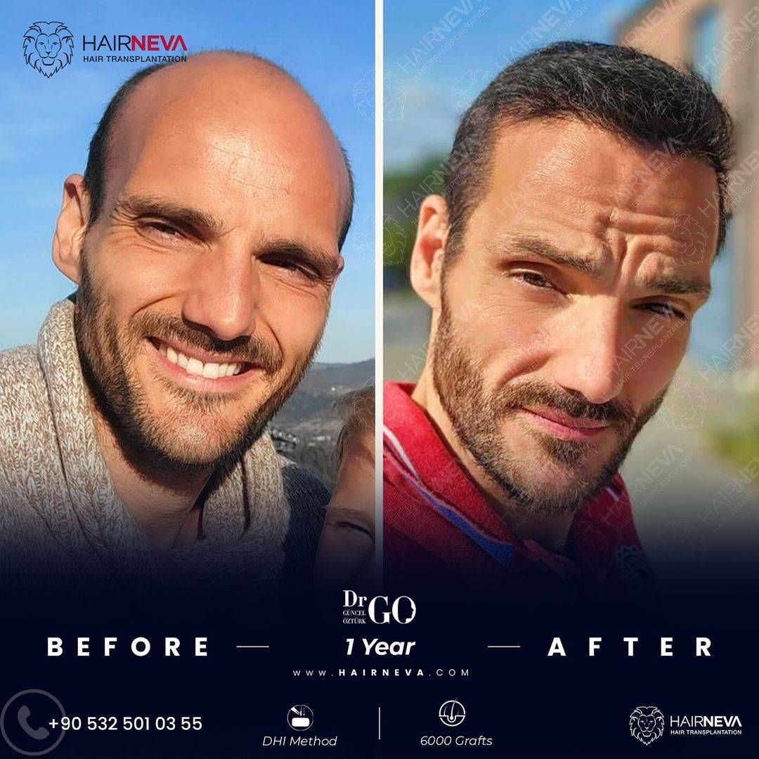 Hair Transplant in Turkey vs. Istanbul: What’s the Difference? - Hairneva